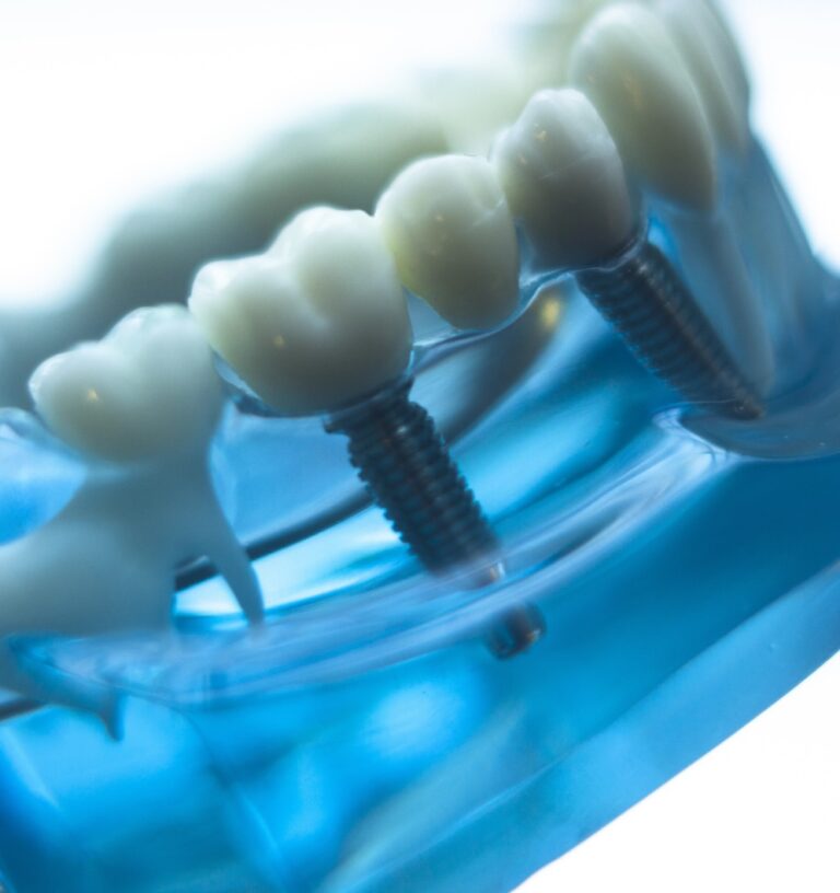 Dental Implants | Dedicated Sleep (888) 342-1827